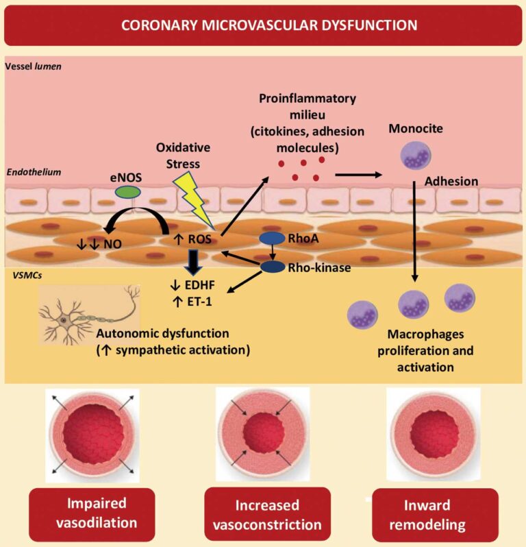 Pathophysiology of Coronary Microvascular Dysfunction – INOCA INTERNATIONAL